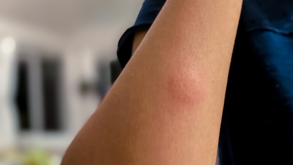 Wat te doen bij een allergische reactie op een muggenbeet? | PlusOnline