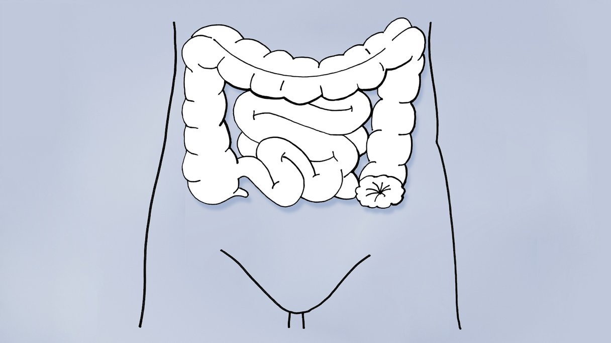 Wat is een colostoma? | PlusOnline