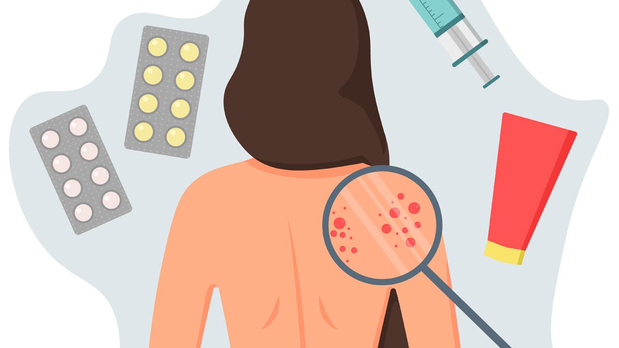 Tips om huidschimmel te voorkomen | PlusOnline