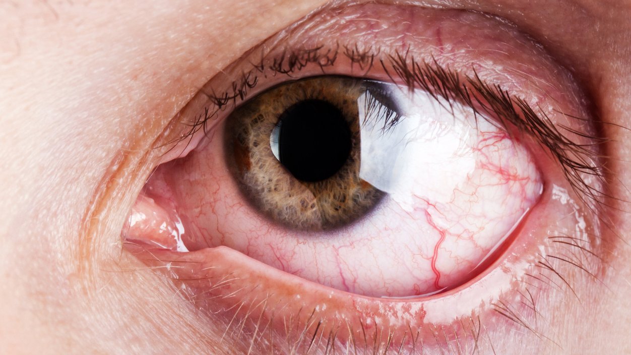 Is een rood oog iets om bezorgd over te zijn? | PlusOnline