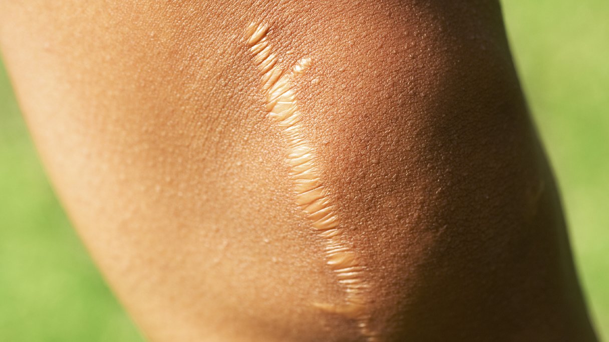 6 vragen over littekens | PlusOnline