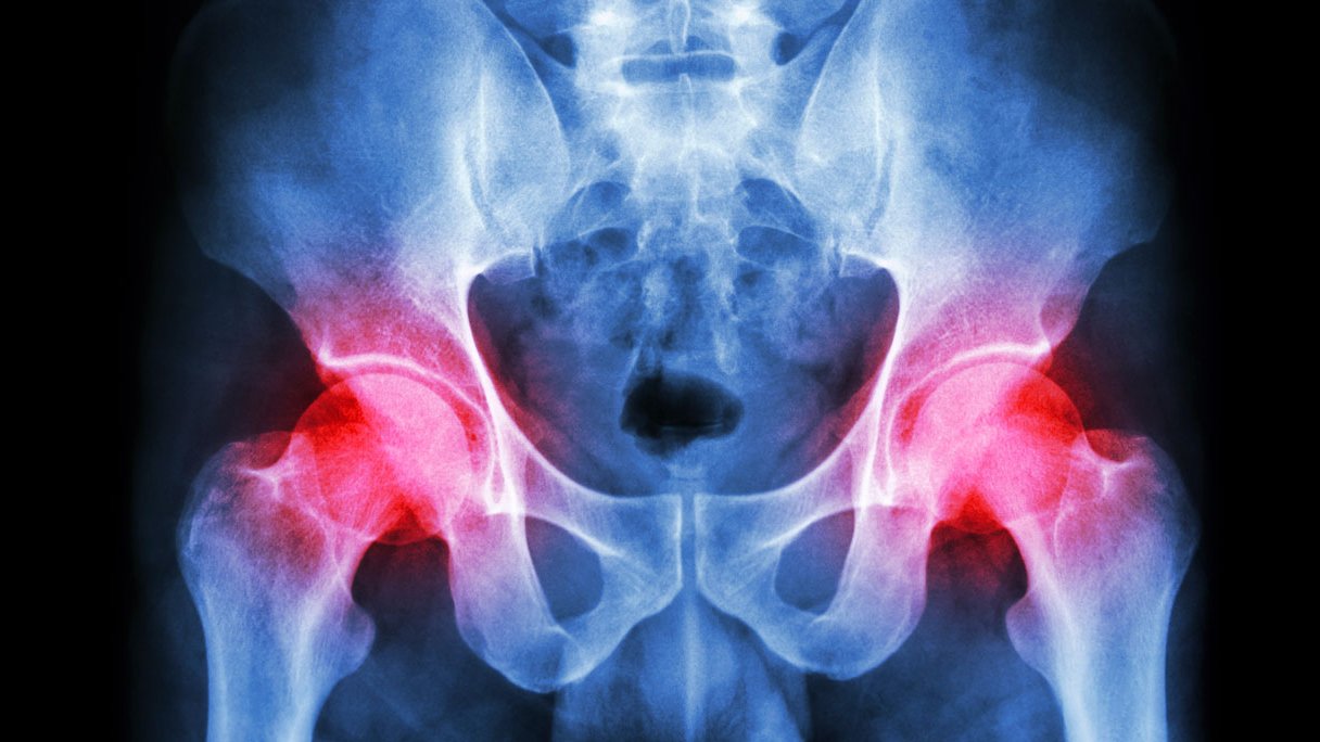 Video: heupvervanging | PlusOnline